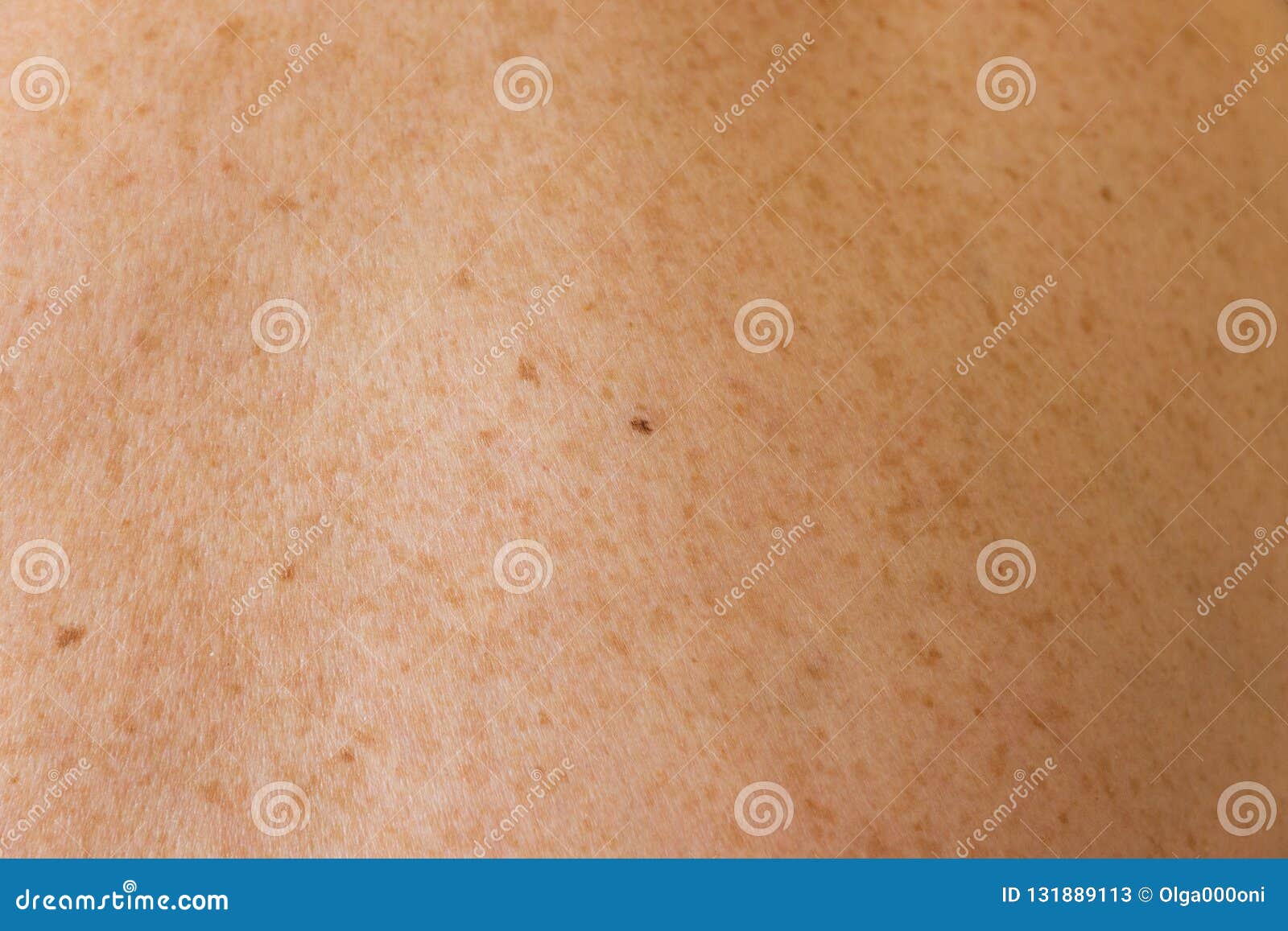 Human Skin Covered with Freckes Texture Stock Image - Image of freckled ...