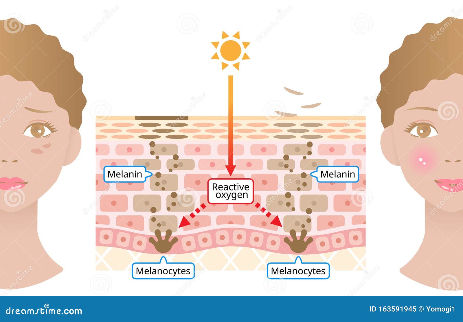 Skin Mechanism Of Blotches Cartoon Vector | CartoonDealer.com #71939071 Skin Mechanism Of Blotches Cartoon Vector | CartoonDealer.com #71939071