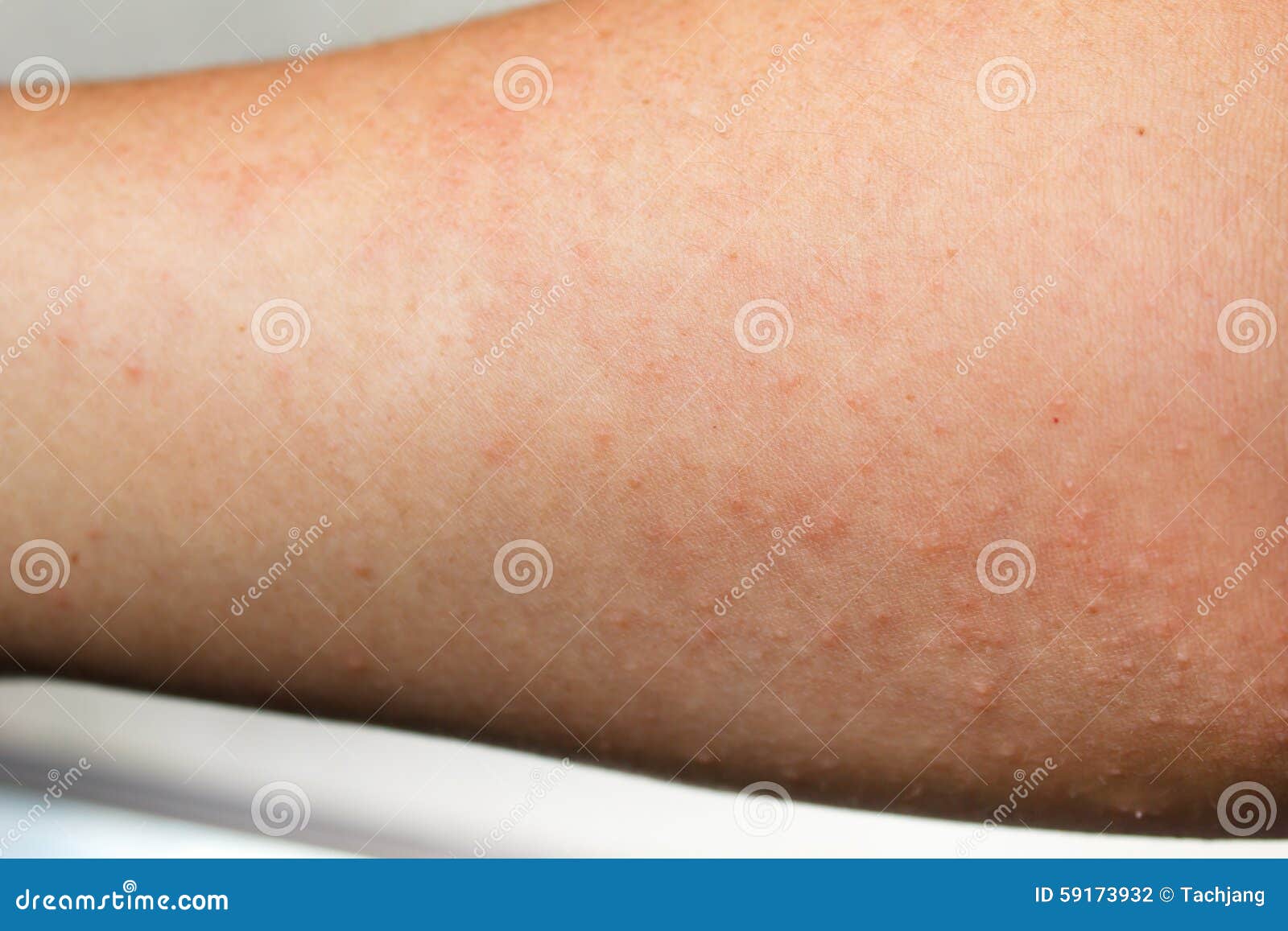 Human Skin, Presenting an Allergic Reaction. Stock Photo - Image of ...