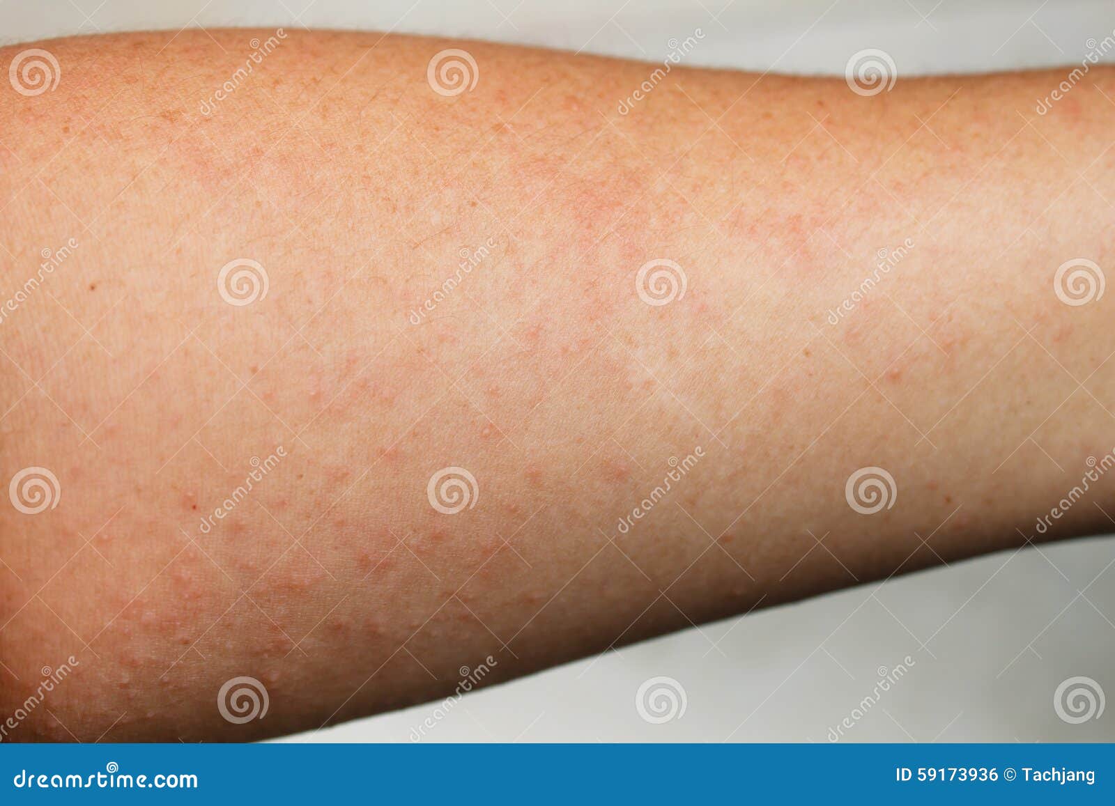 Human Skin, Presenting an Allergic Reaction. Stock Photo - Image of ...
