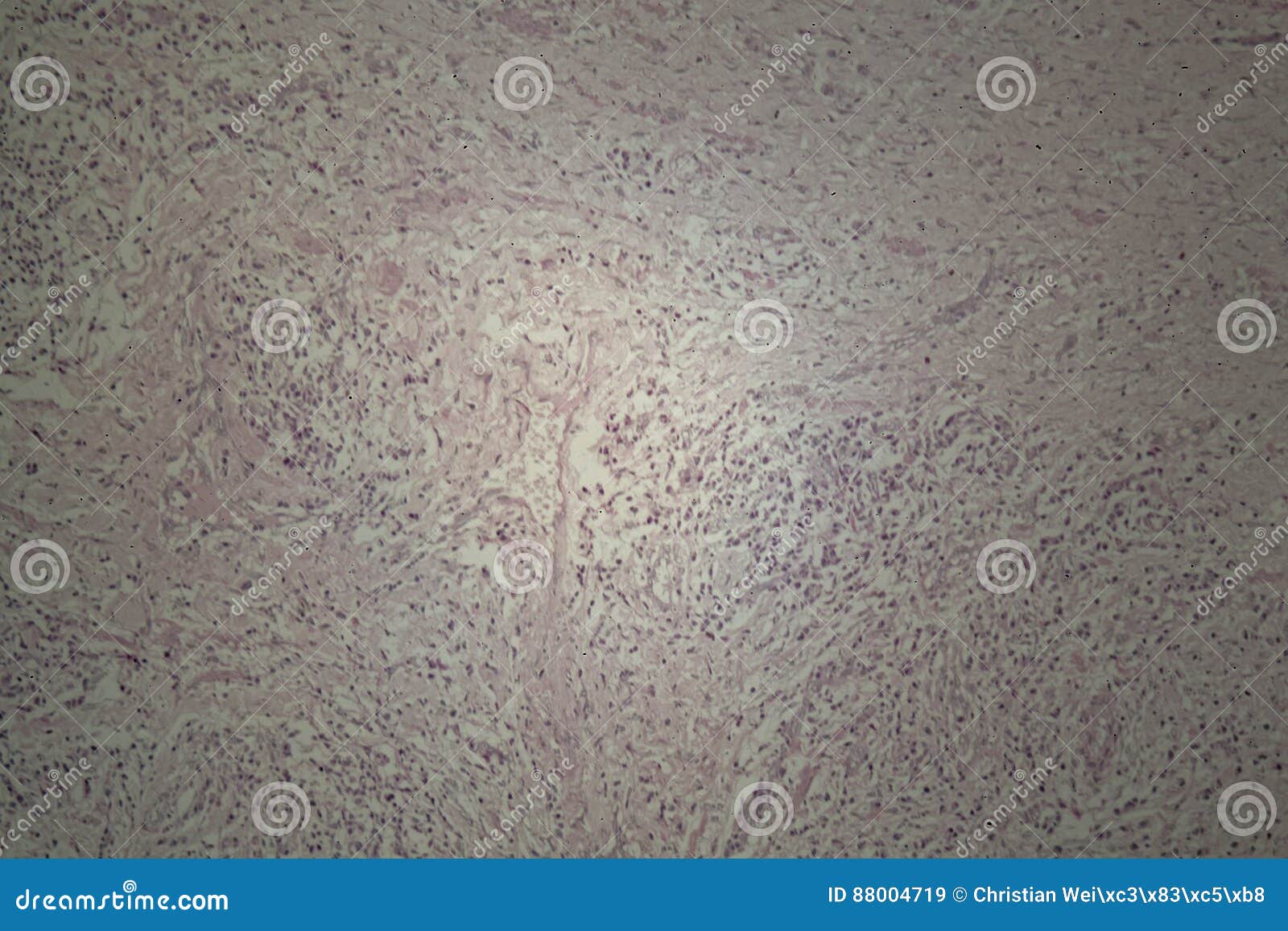 Human Skin with Squamous Cell Carcinoma Stock Image - Image of ...