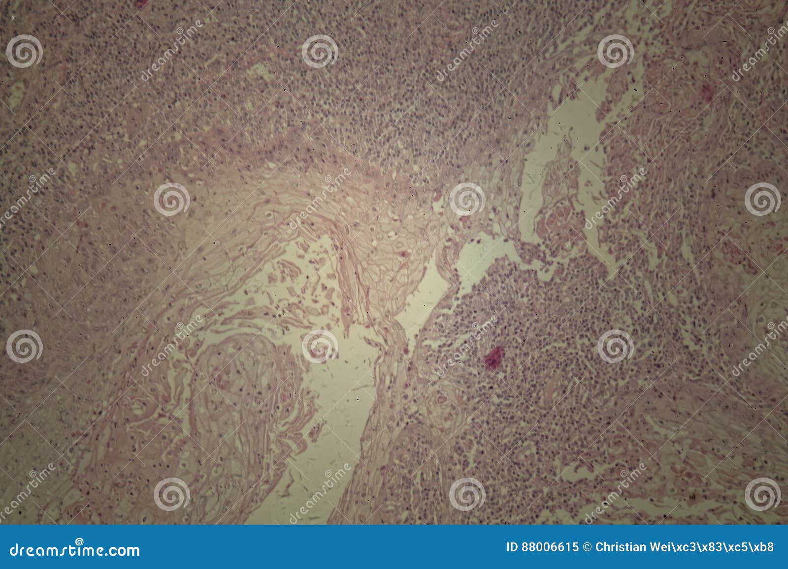 Human Skin with Squamous Cell Carcinoma Stock Image - Image of cells ...