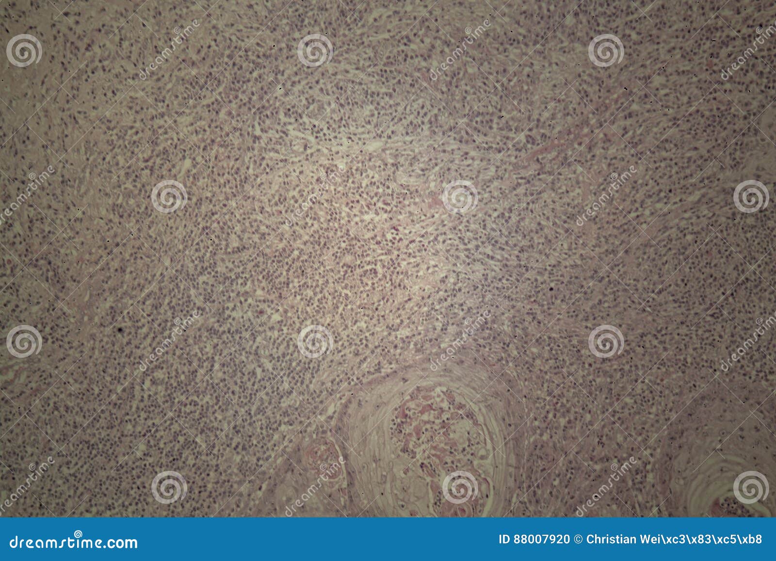 Human Squamous Cell Carcinoma. Tissues Affected By Cancer Cells Under A ...