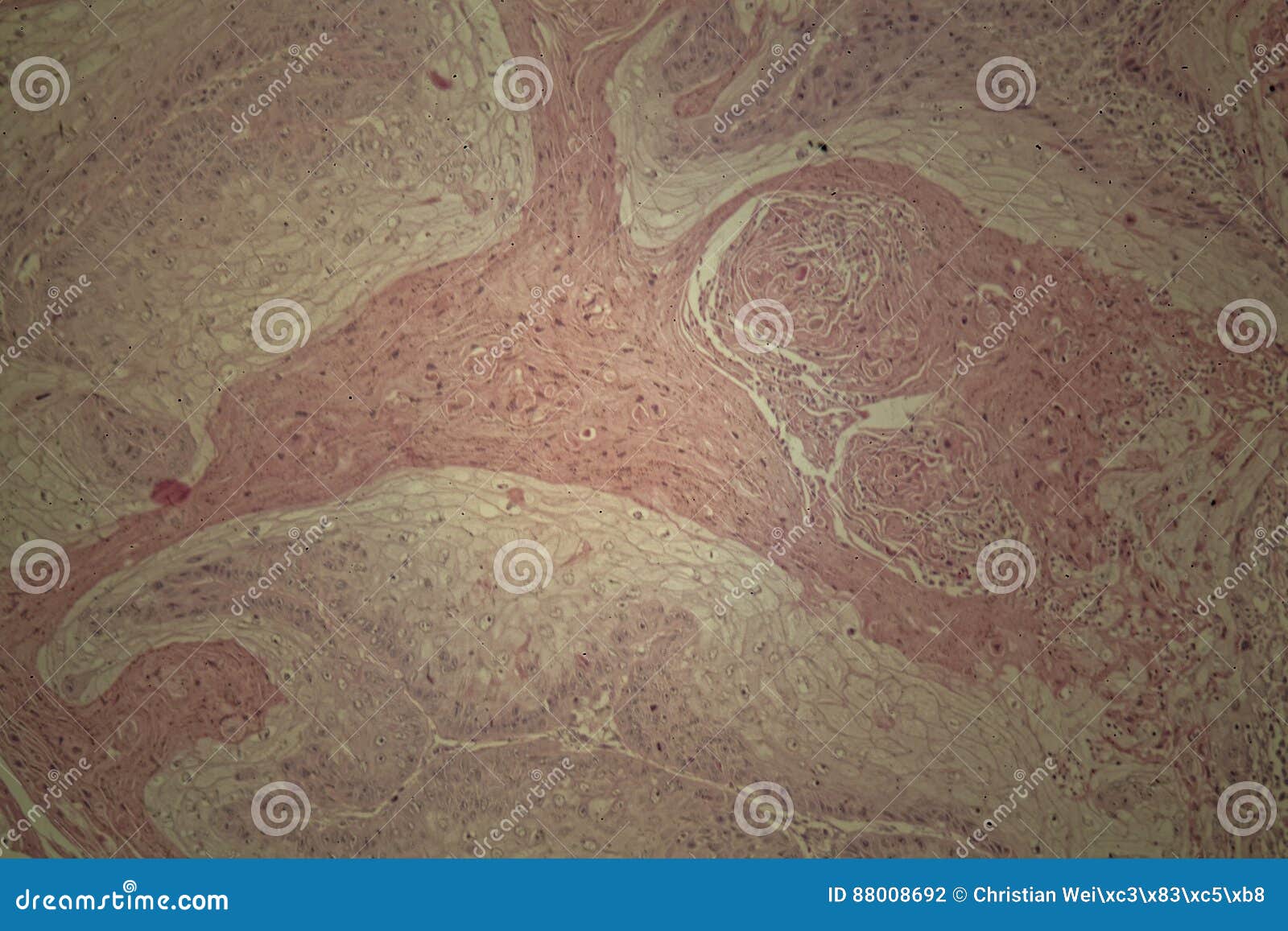 Human Squamous Cell Carcinoma. Tissues Affected By Cancer Cells Under A ...