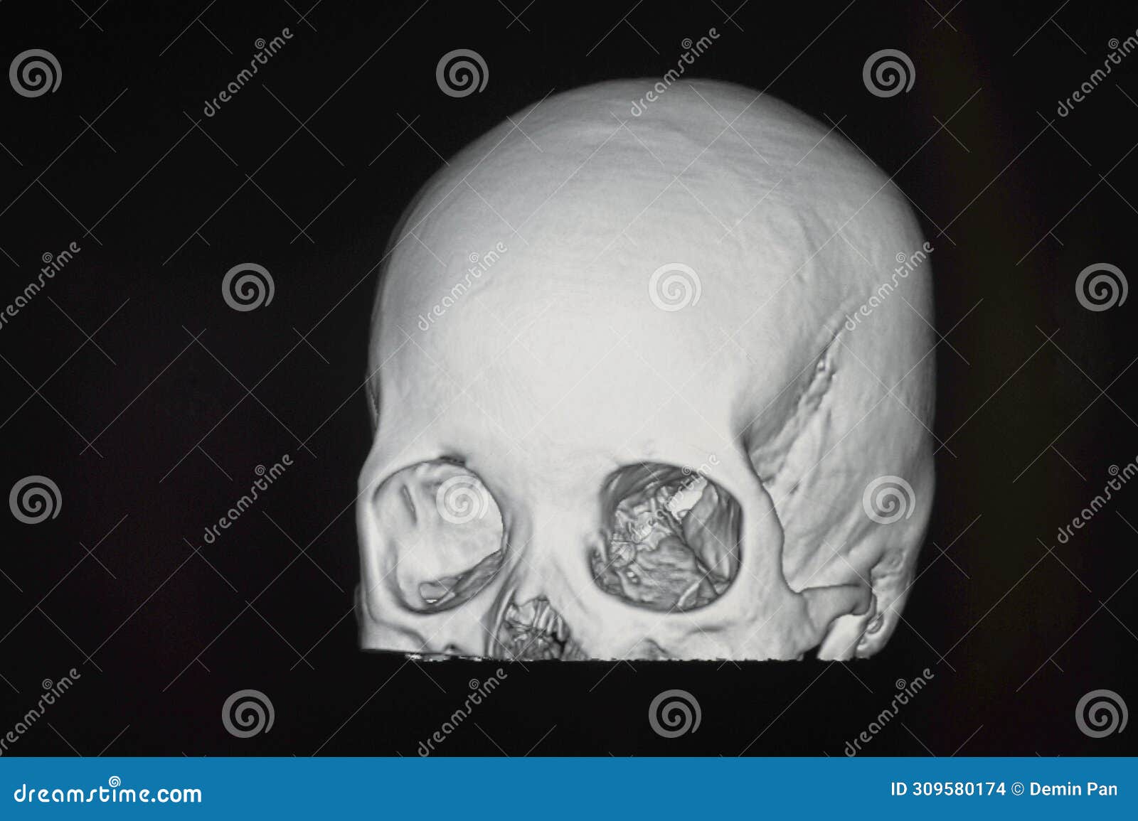Human skull CT scans stock photo. Image of care, neurosurgery - 309580174