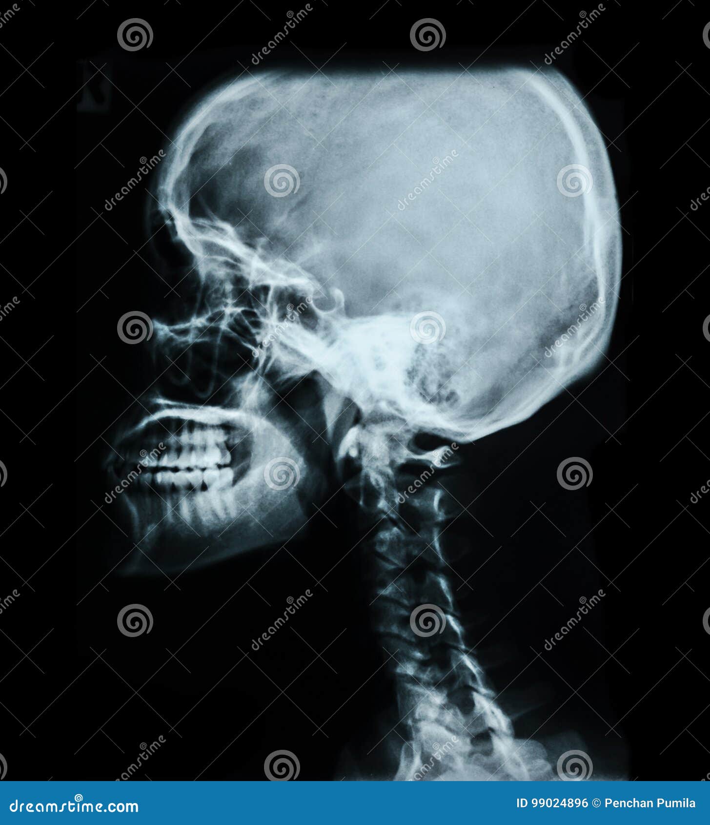 Human skull X-ray image. stock photo. Image of dentist - 99024896