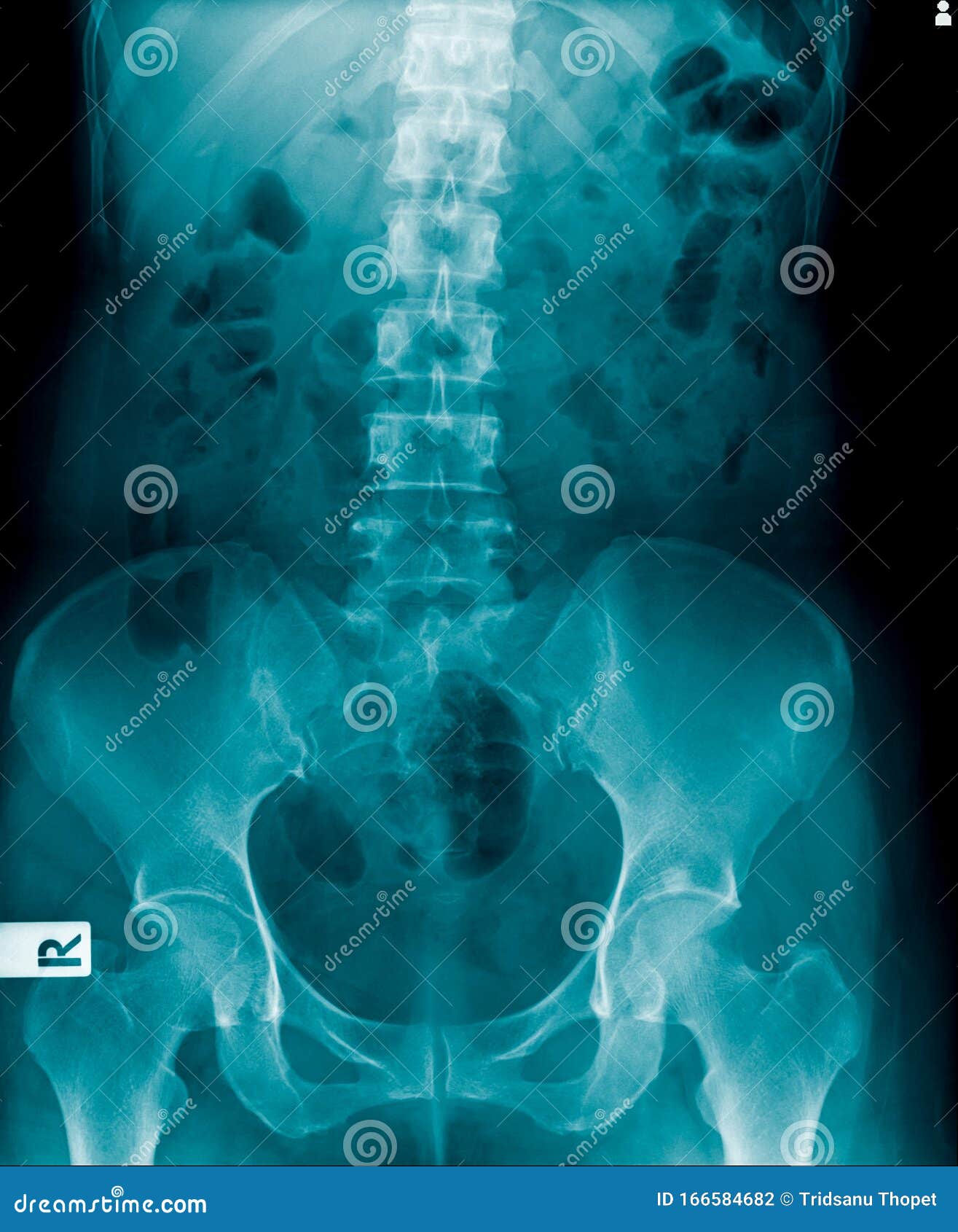 Human spine in blue tone stock photo. Image of background - 166584682