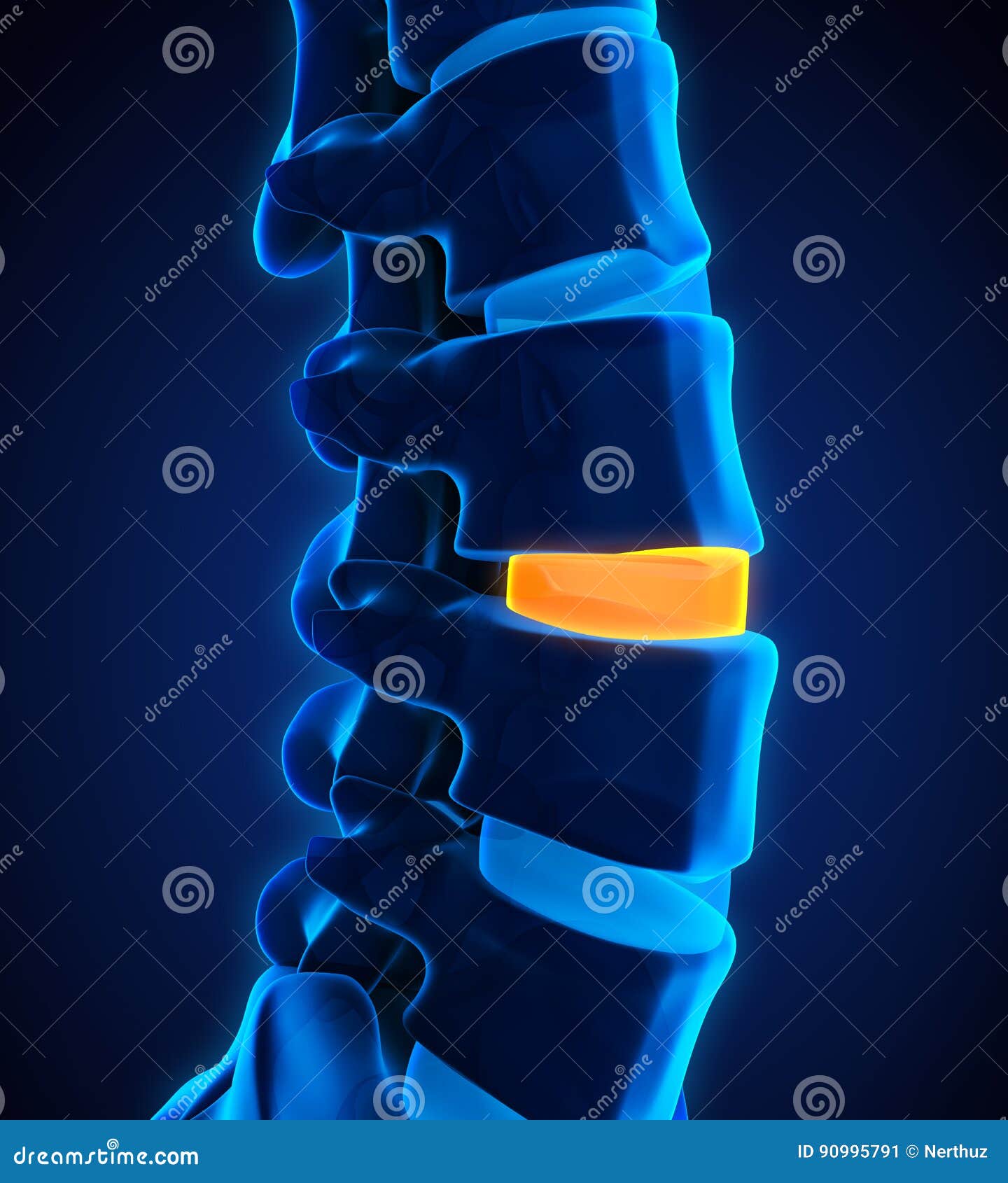 Human Spine Disc Degenerative Stock Illustration - Illustration of ...
