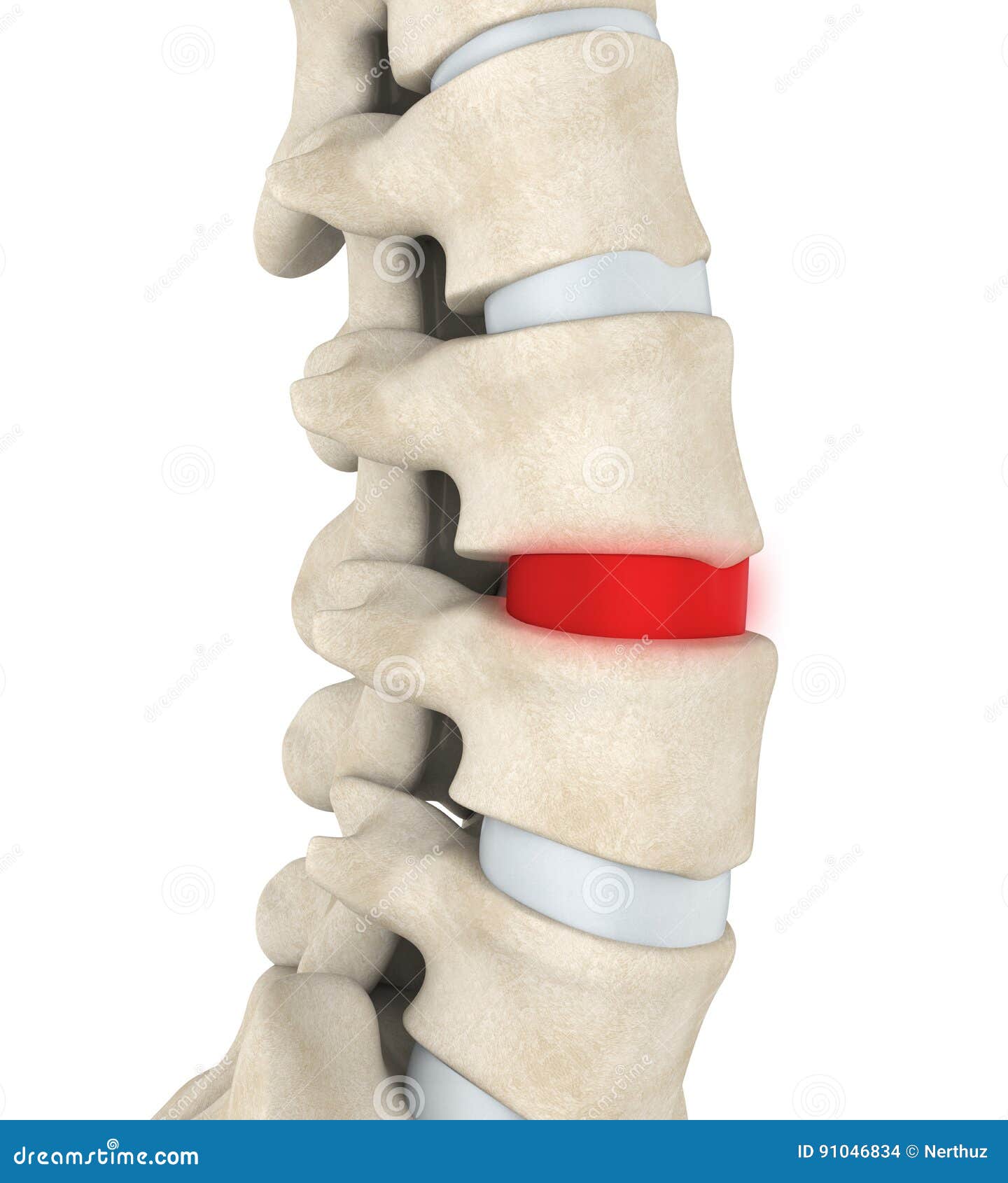 Human Spine Disc Degenerative Stock Illustration - Illustration of ...
