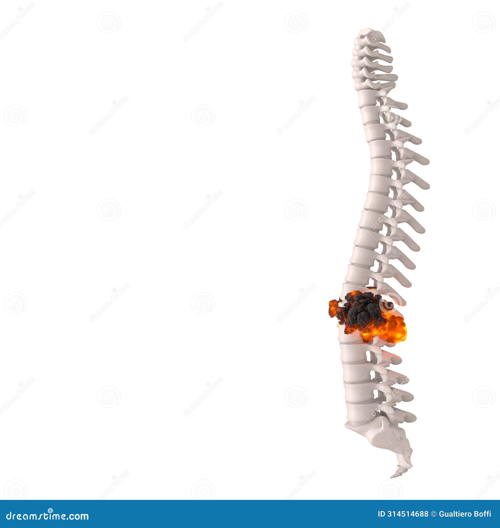 Human Spine with Disc Herniation Concept Stock Illustration ...
