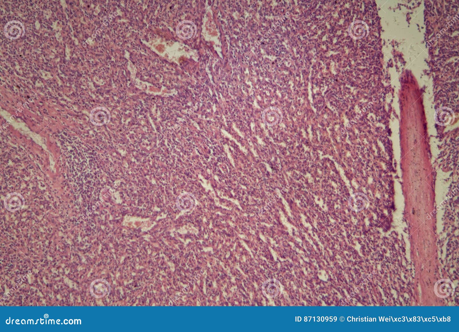 Human Spleen with Chronic Myelogenous Leukemia Stock Image - Image of ...