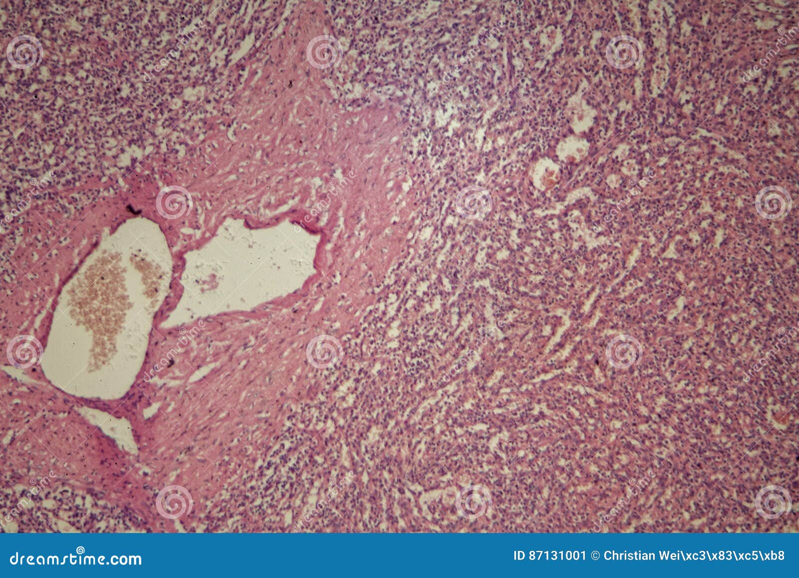 Human Spleen with Chronic Myelogenous Leukemia Stock Image - Image of ...