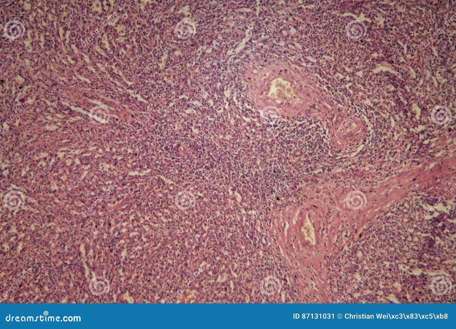 Human Spleen with Chronic Myelogenous Leukemia Stock Image - Image of ...