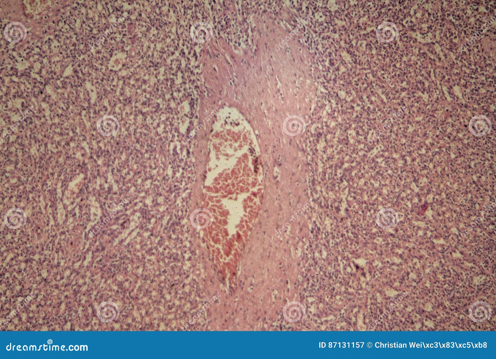 Human Spleen with Chronic Myelogenous Leukemia Stock Image - Image of ...