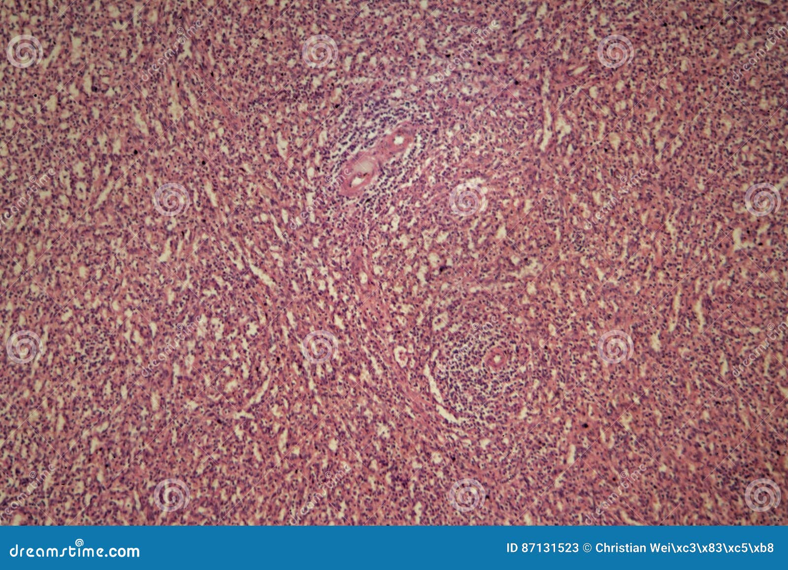 Human Spleen with Chronic Myelogenous Leukemia Stock Image - Image of ...