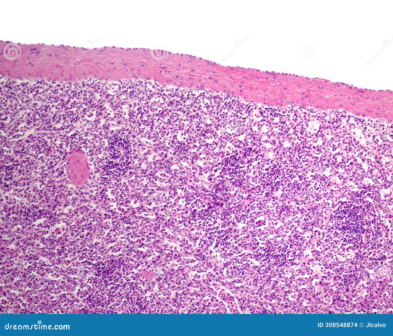 Splenic Capsule Hyaline Degeneration Stock Image | CartoonDealer.com ...