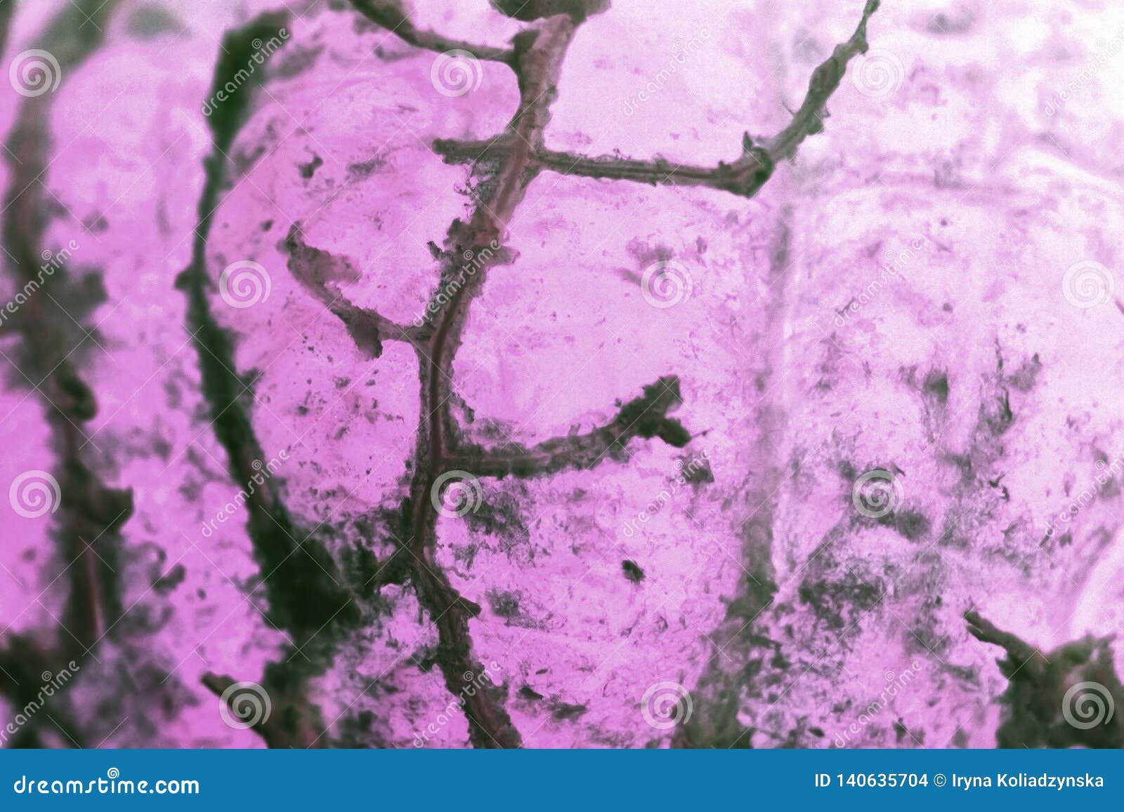 Human Squamous Cell Carcinoma. Tissues Affected by Cancer Cells Under a ...