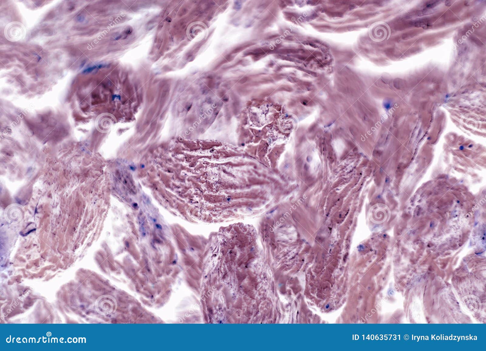 Human Squamous Cell Carcinoma. Tissues Affected by Cancer Cells Under a ...