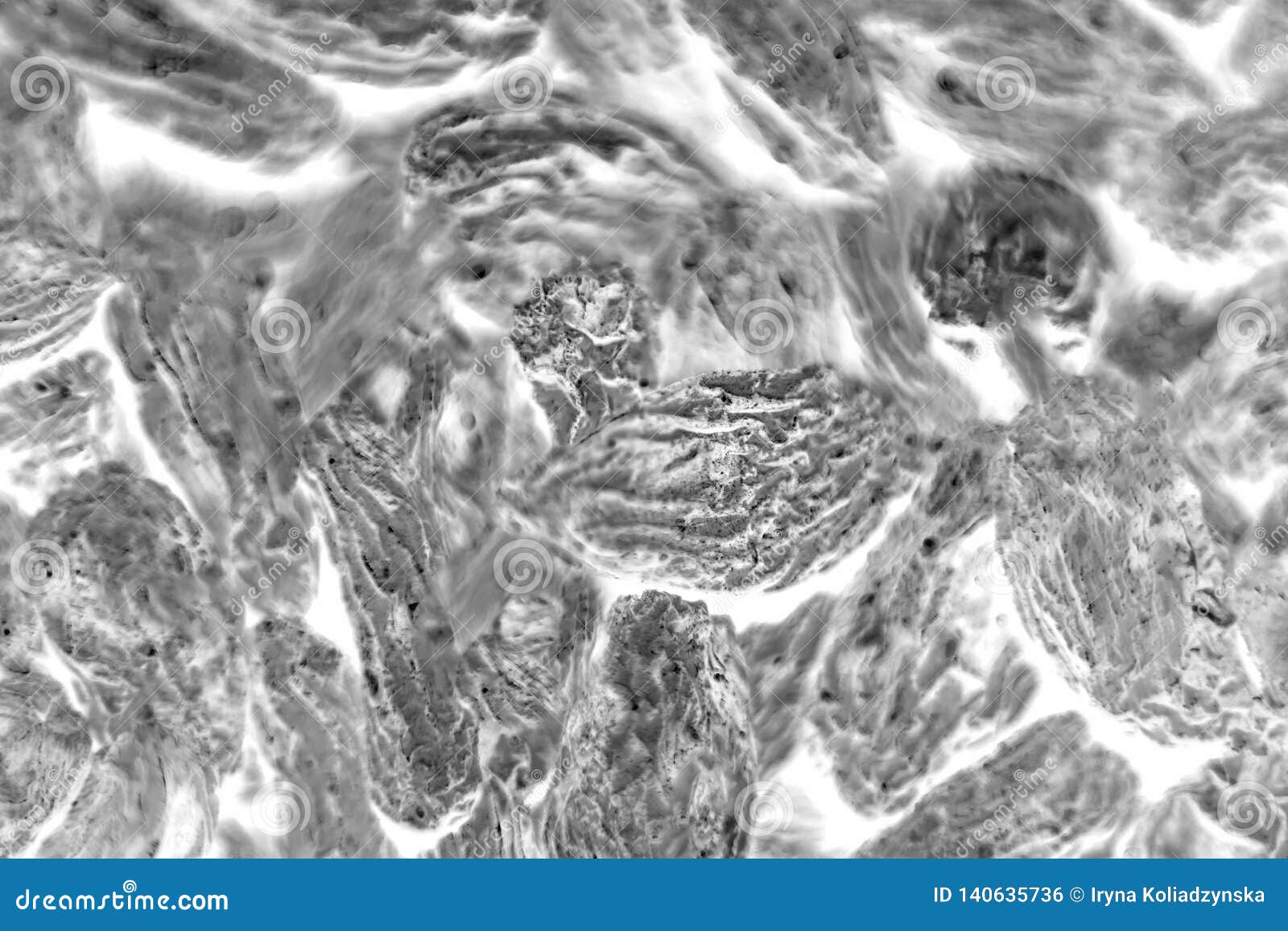 Human Squamous Cell Carcinoma. Tissues Affected by Cancer Cells Under a ...