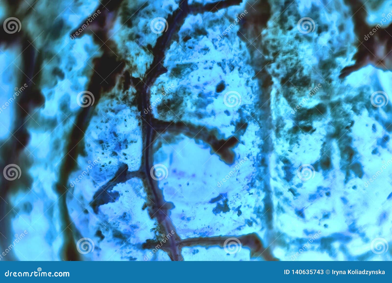 Human Squamous Cell Carcinoma. Tissues Affected by Cancer Cells Under a ...