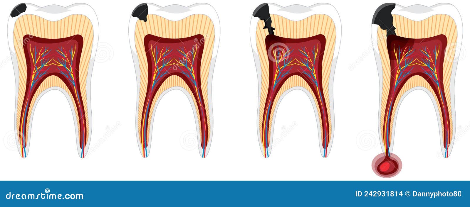 Human in the Stages of Tooth Decay Stock Vector - Illustration of ...