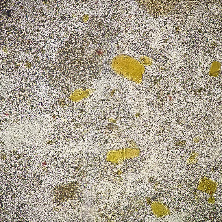 Human Stool Sample Under Microscope Stock Image - Image of nature ...