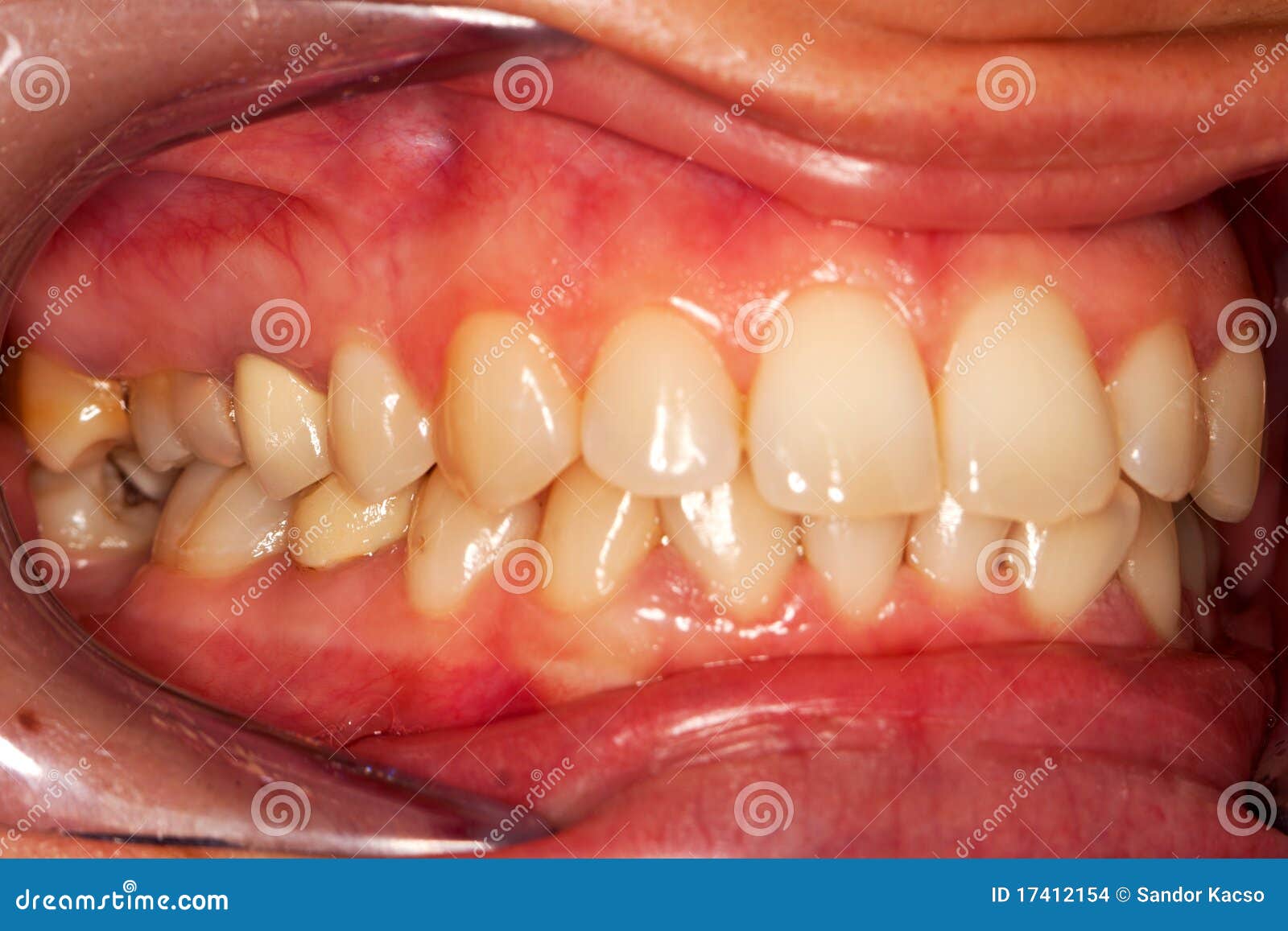Human teeth stock photo. Image of caring, symptoms, gums - 17412154