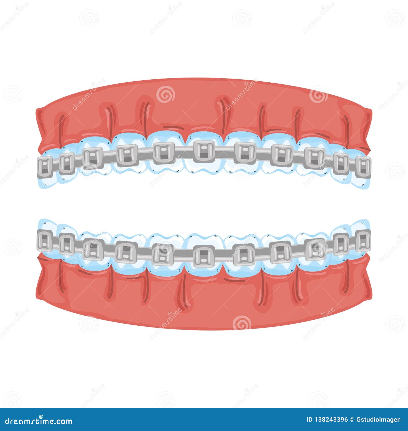 Human Teeth with Orthodontics Stock Vector - Illustration of clinical ...