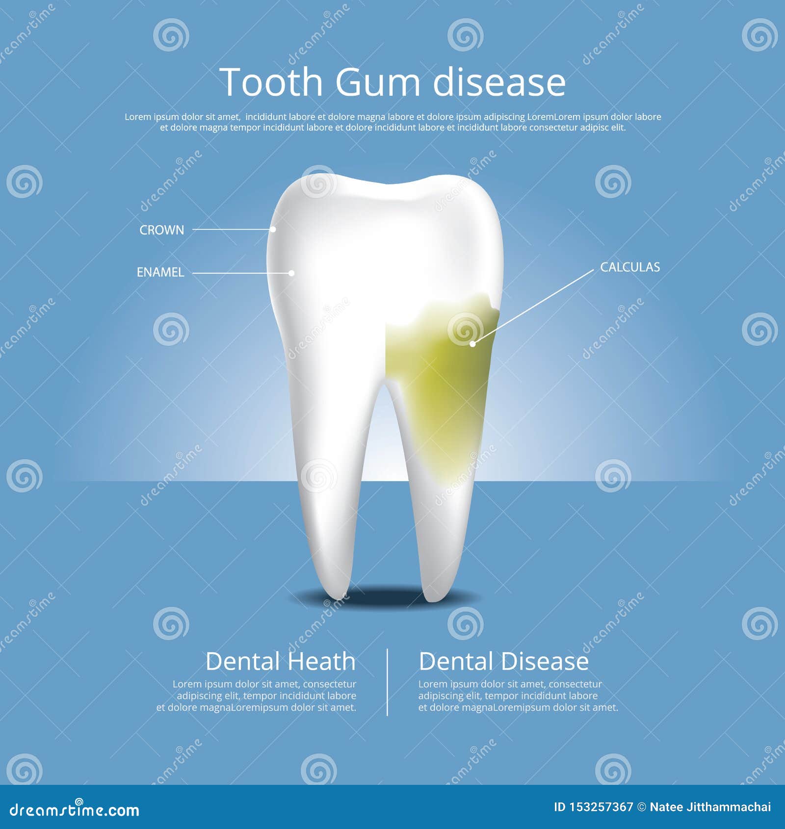 Stages Of Gum Disease Infographic Illustration. Dental And Oral Care ...