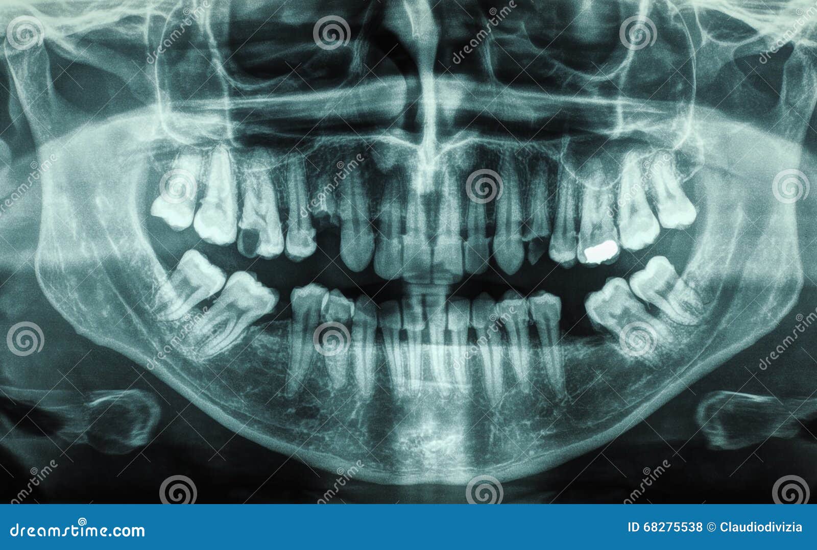 Human teeth xray stock photo. Image of cure, skeleton - 68275538