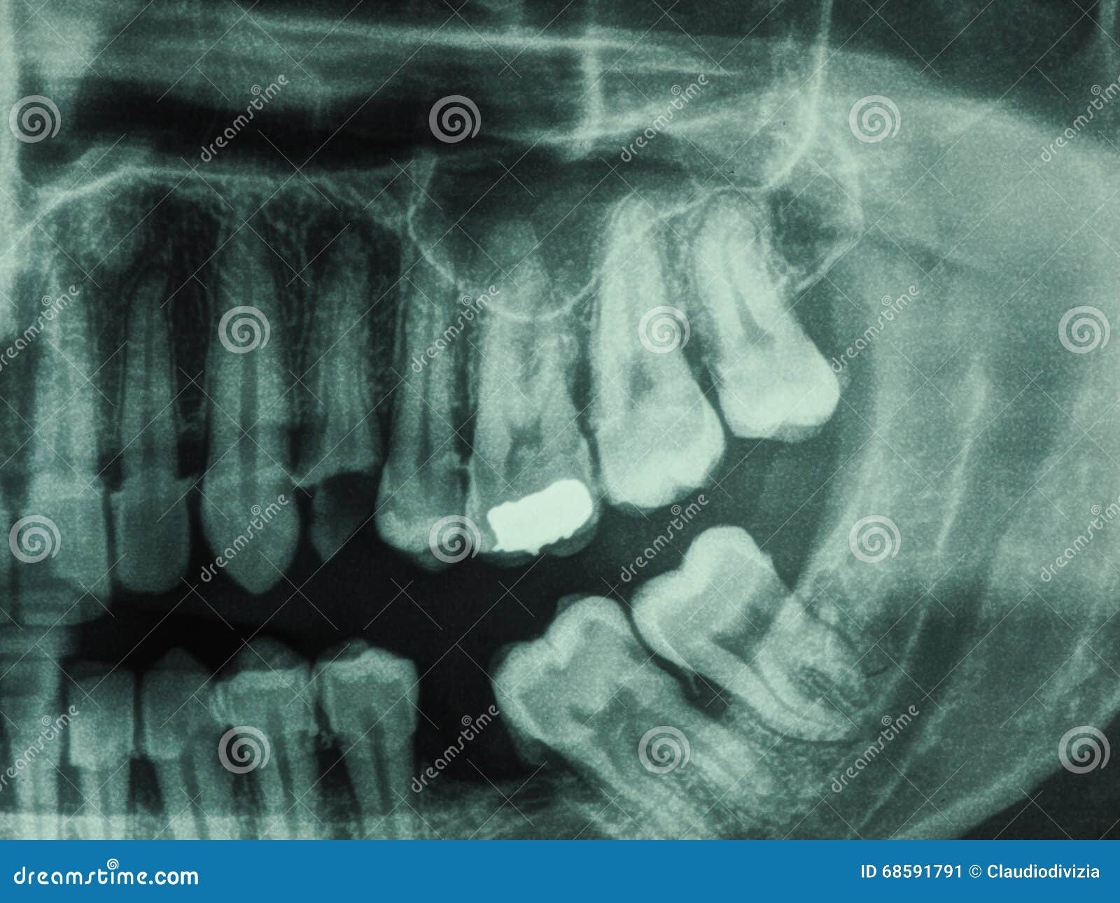 Human teeth xray stock image. Image of xray, cure, dental - 68591791