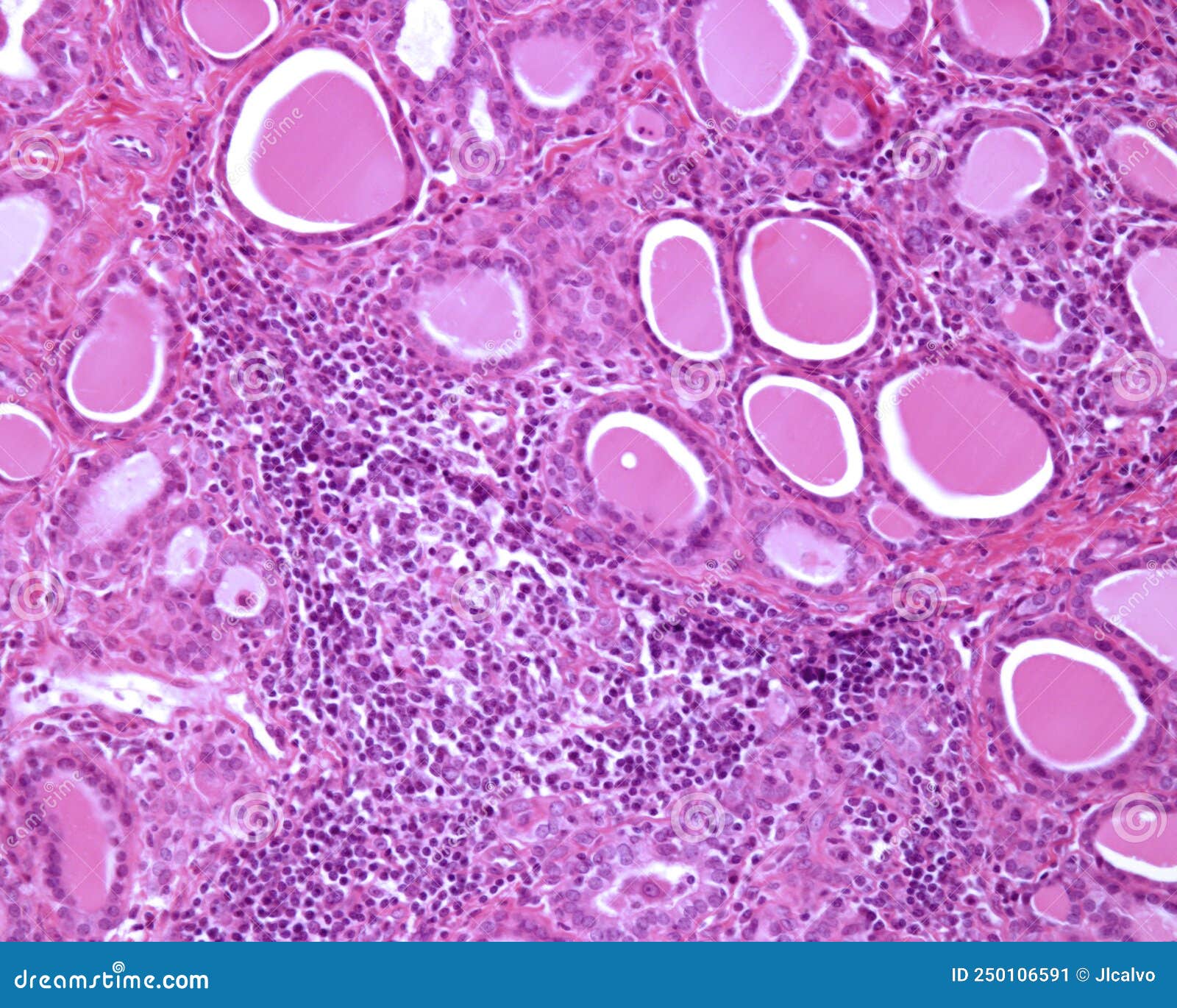 Human Thyroid. Chronic Thyroiditis Stock Image - Image of hashimoto ...