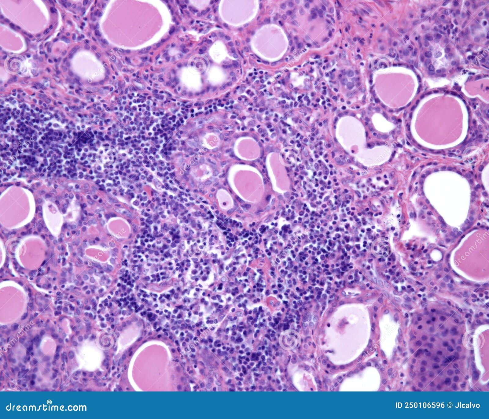 Hashimoto`s Thyroiditis Disease Royalty-Free Stock Photo ...