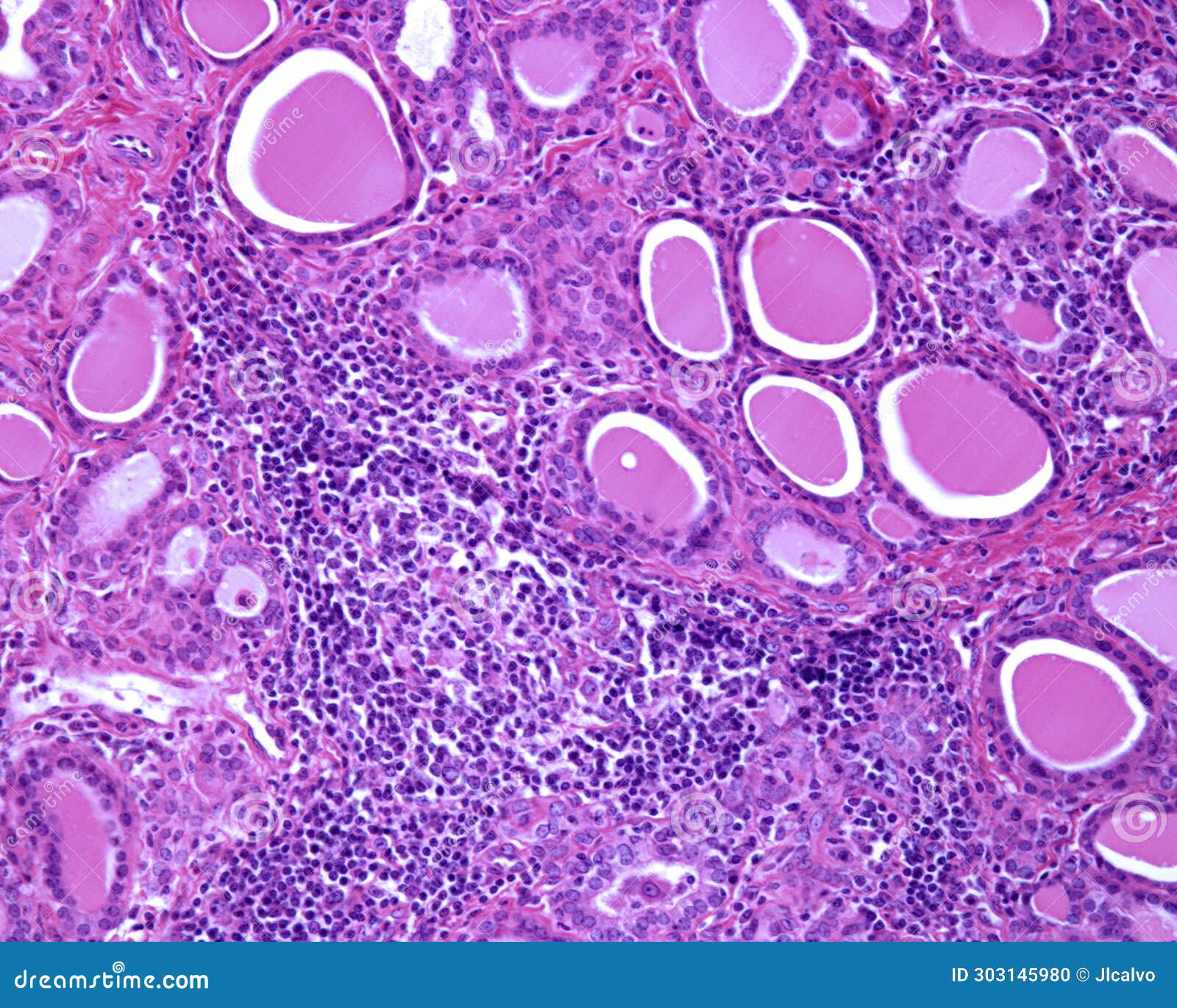 Human Thyroid Gland With Goiter Caused By Deficiency Of Iodine Under A ...