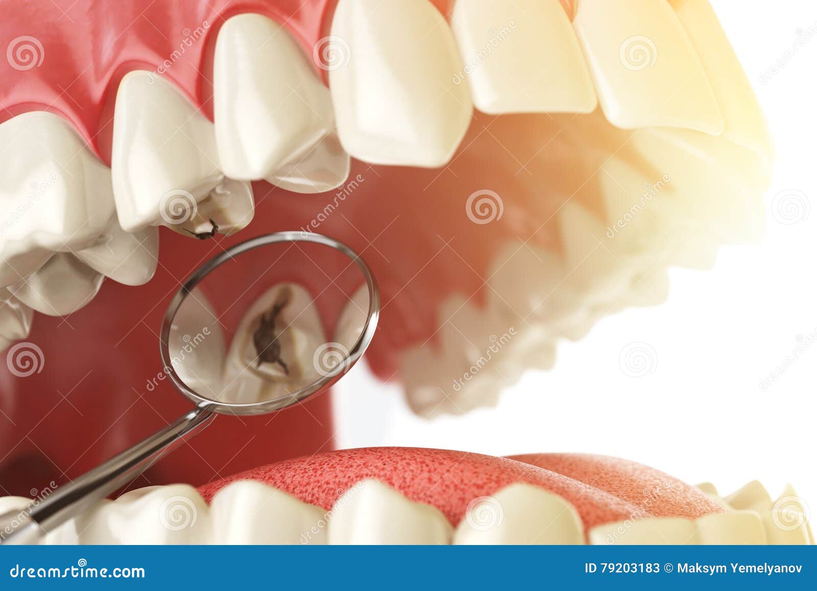 Human Tooth with Caries, Hole and Tools. Dental Searching Concept Stock ...