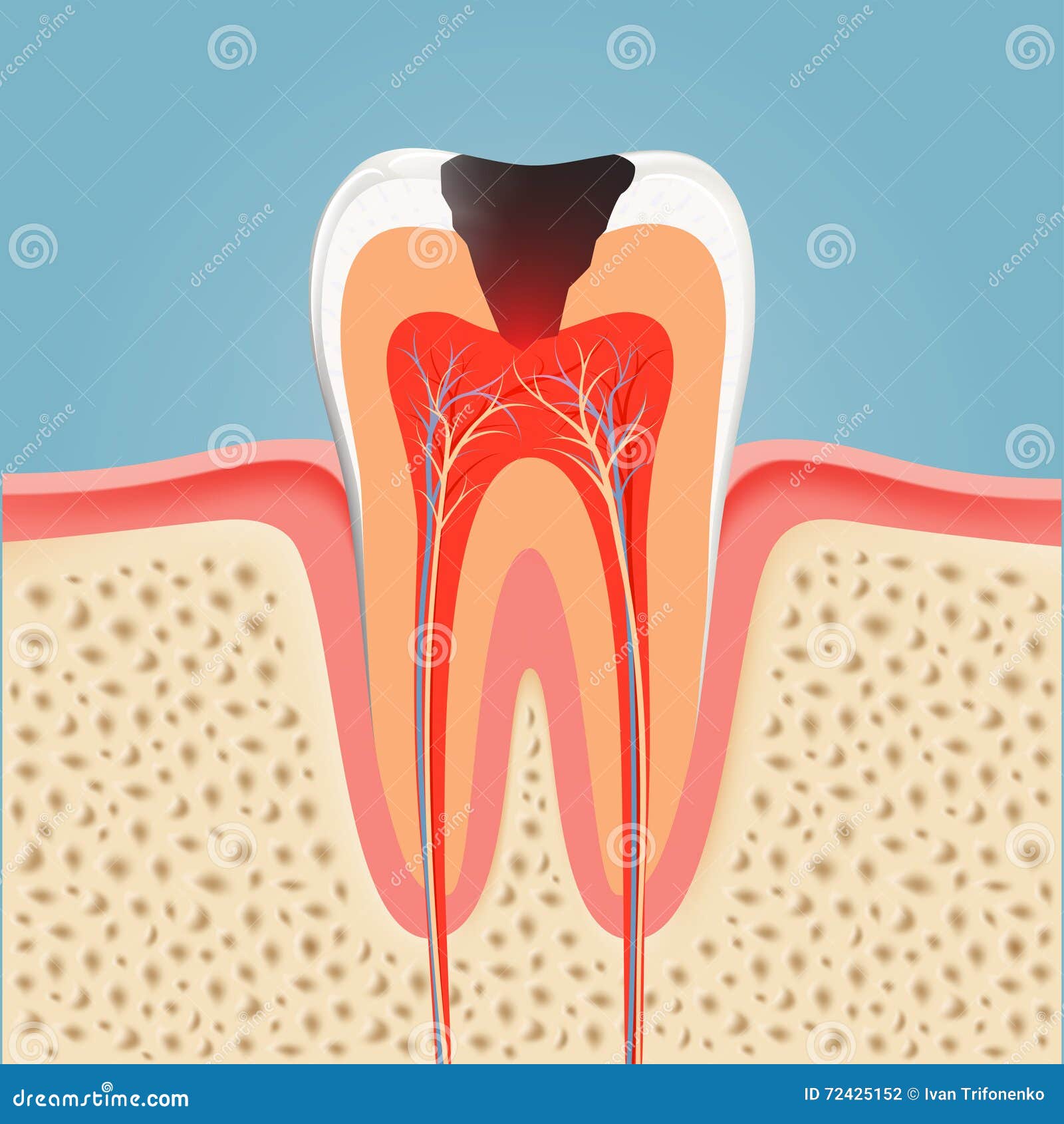 Human Tooth With Caries. Stock Vector Illustration | CartoonDealer.com ...
