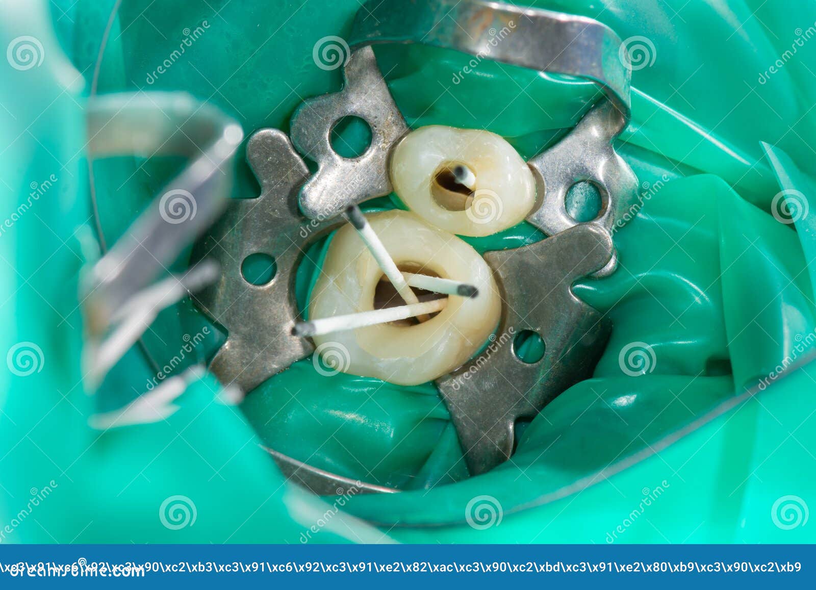 Human Tooth Close-up Macro. Endodontics Treatment of Canals and Pulp of ...