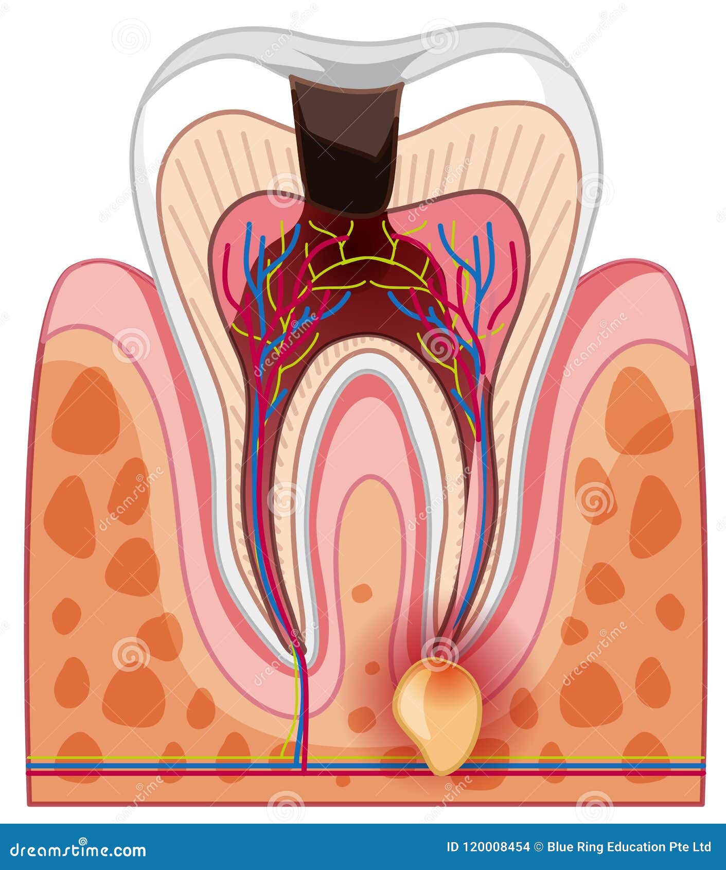 A Human Tooth Decay and Cavity Stock Vector - Illustration of care ...