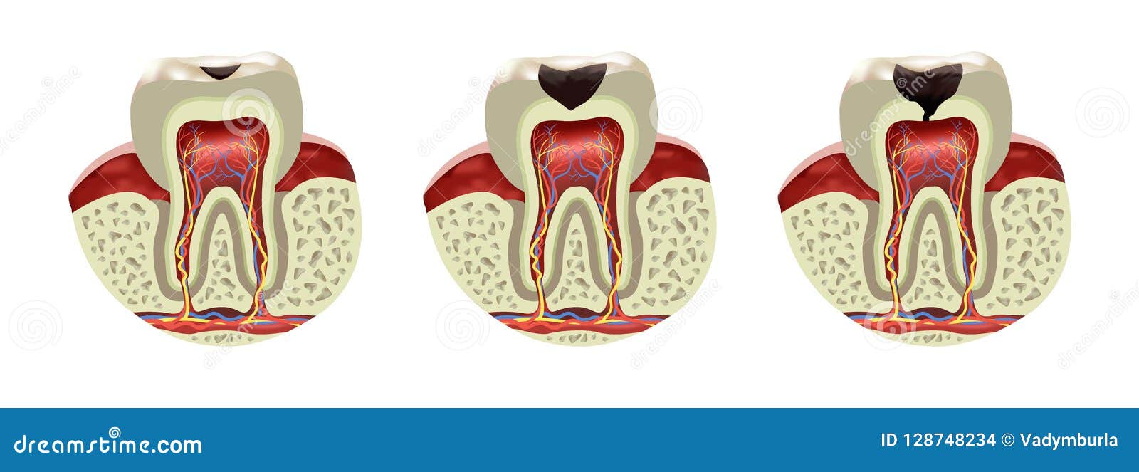 Human Tooth Decay Disease Cross Section Realistic View Stock ...