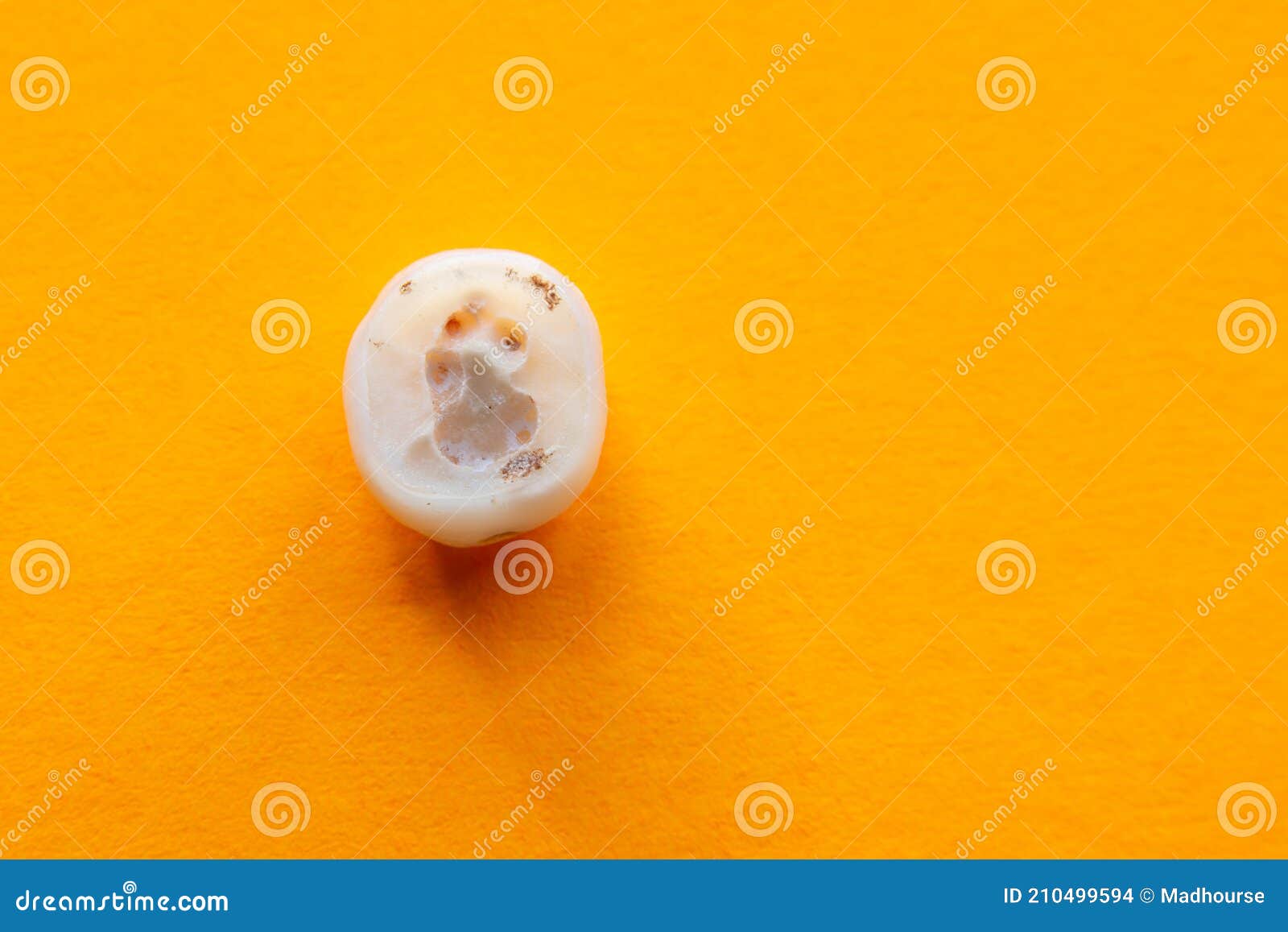 Human Tooth Root Affected by Caries, Close-up on Yellow Background ...