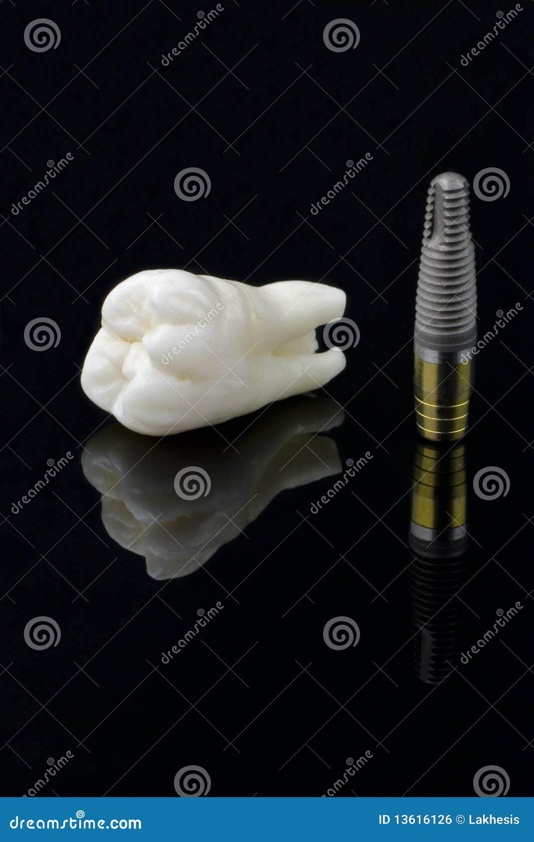 Human Tooth and Titanium Implant Stock Photo - Image of orthodontist ...