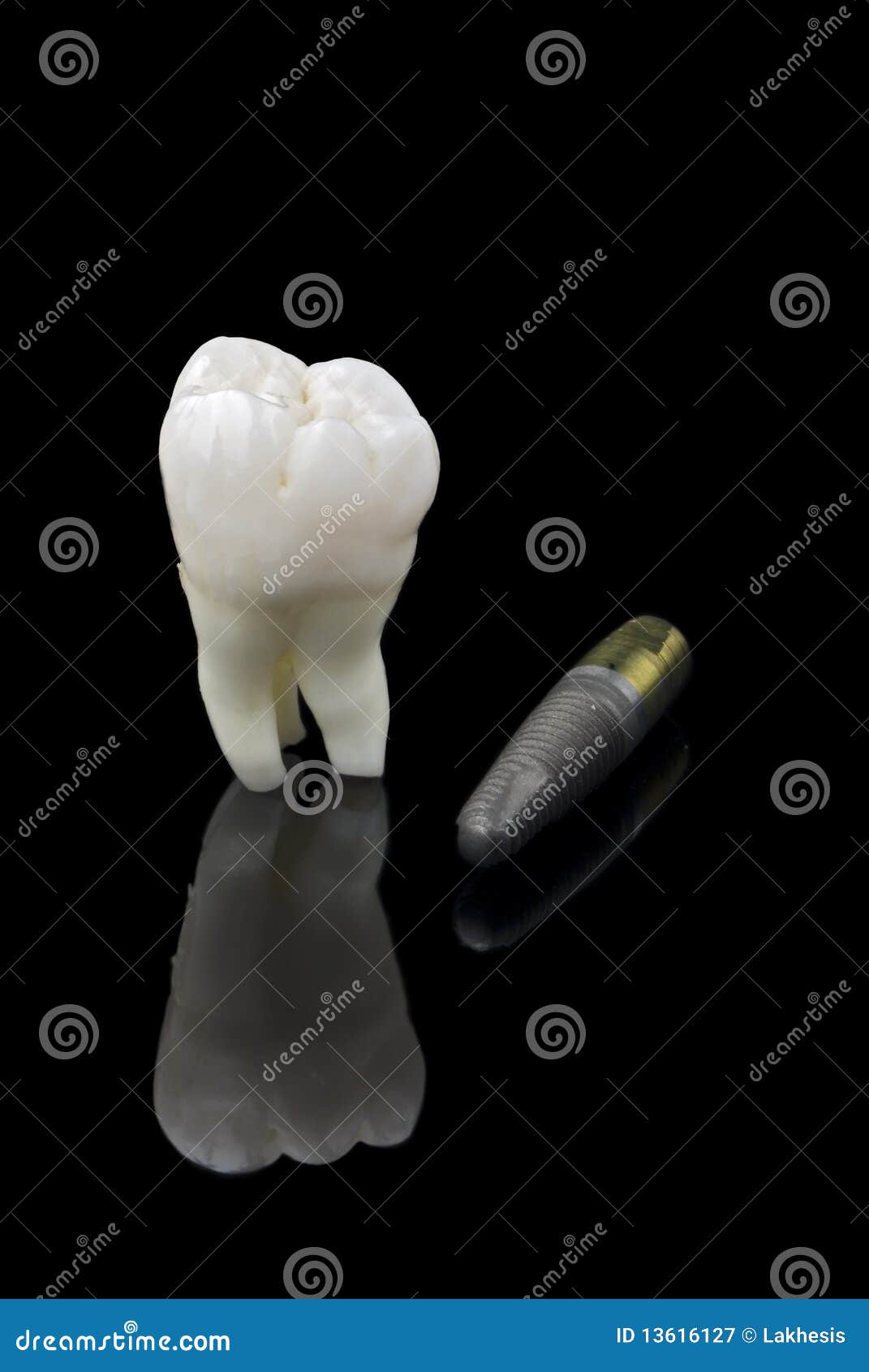 Human Tooth and Titanium Implant Stock Image - Image of mouth, roots ...