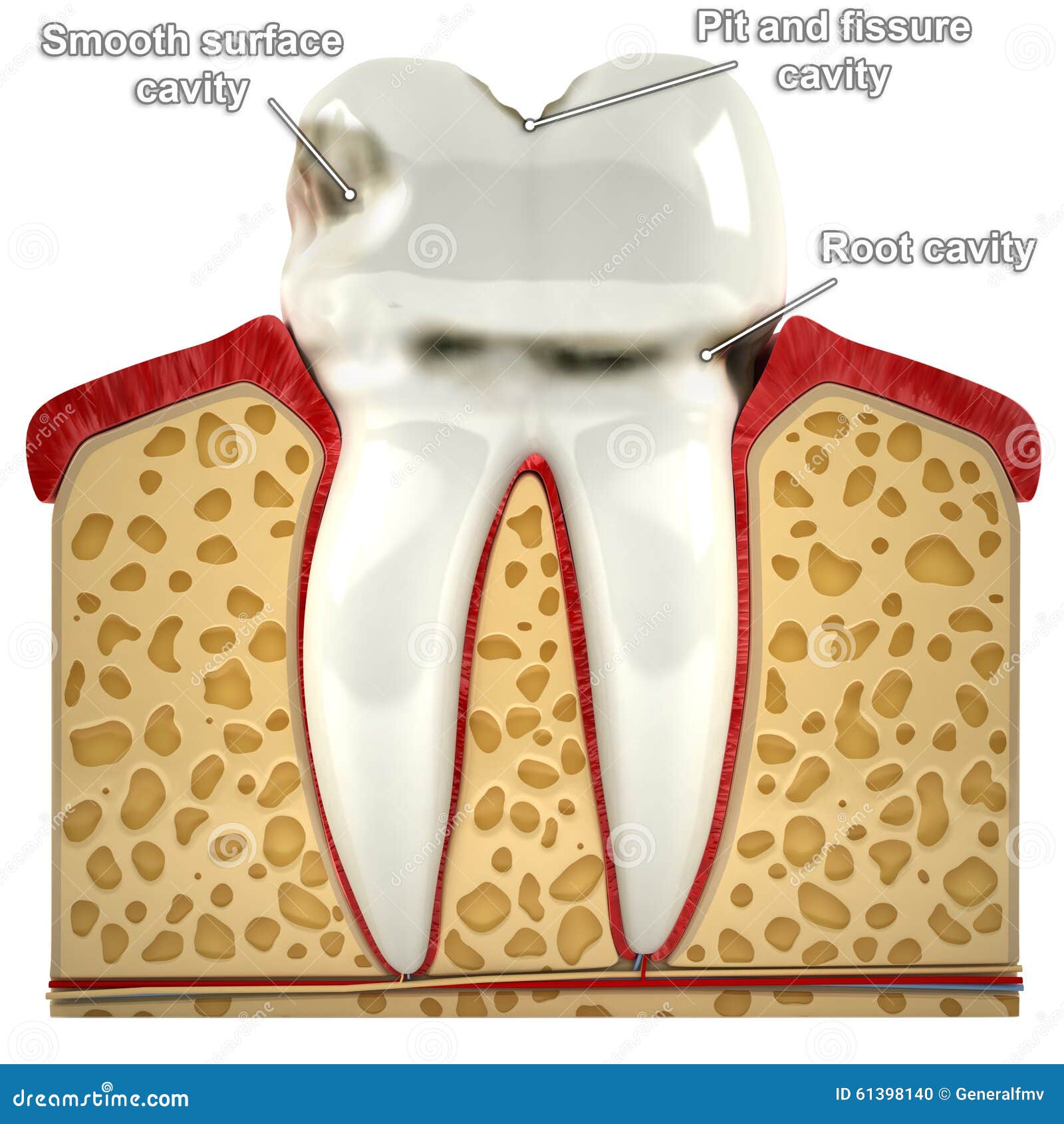 Human Tooth, with Types of Caries (3d Model) Stock Illustration ...
