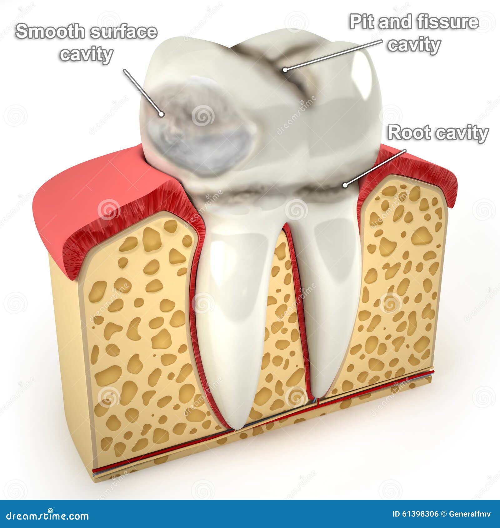 Human Tooth, with Types of Caries (3d Model) Stock Illustration ...