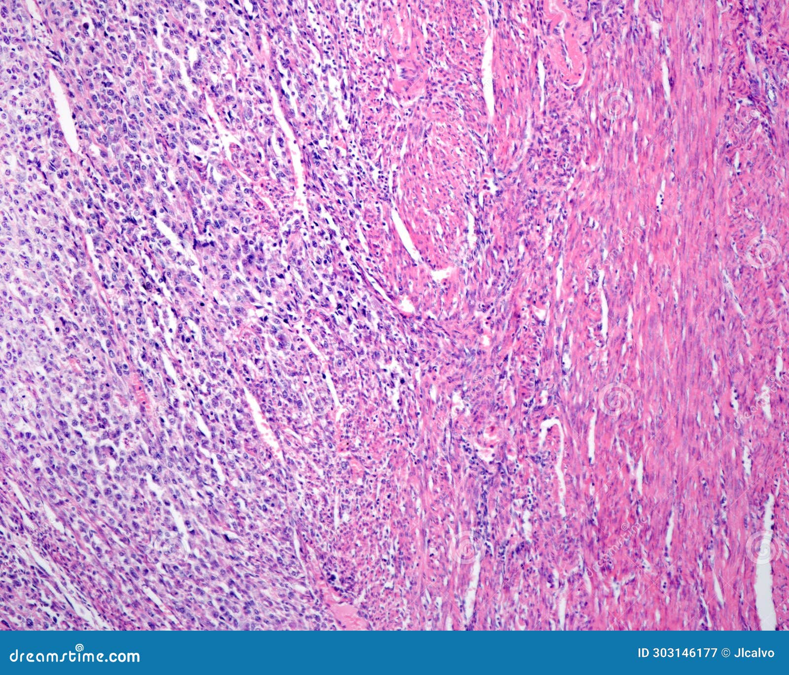 Human Uterus Sarcoma Stock Image Image Of Histopathological 303146177