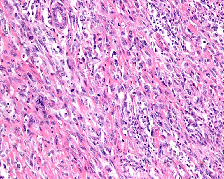 Human Uterus Sarcoma Stock Image Image Of Gynecological 303146227