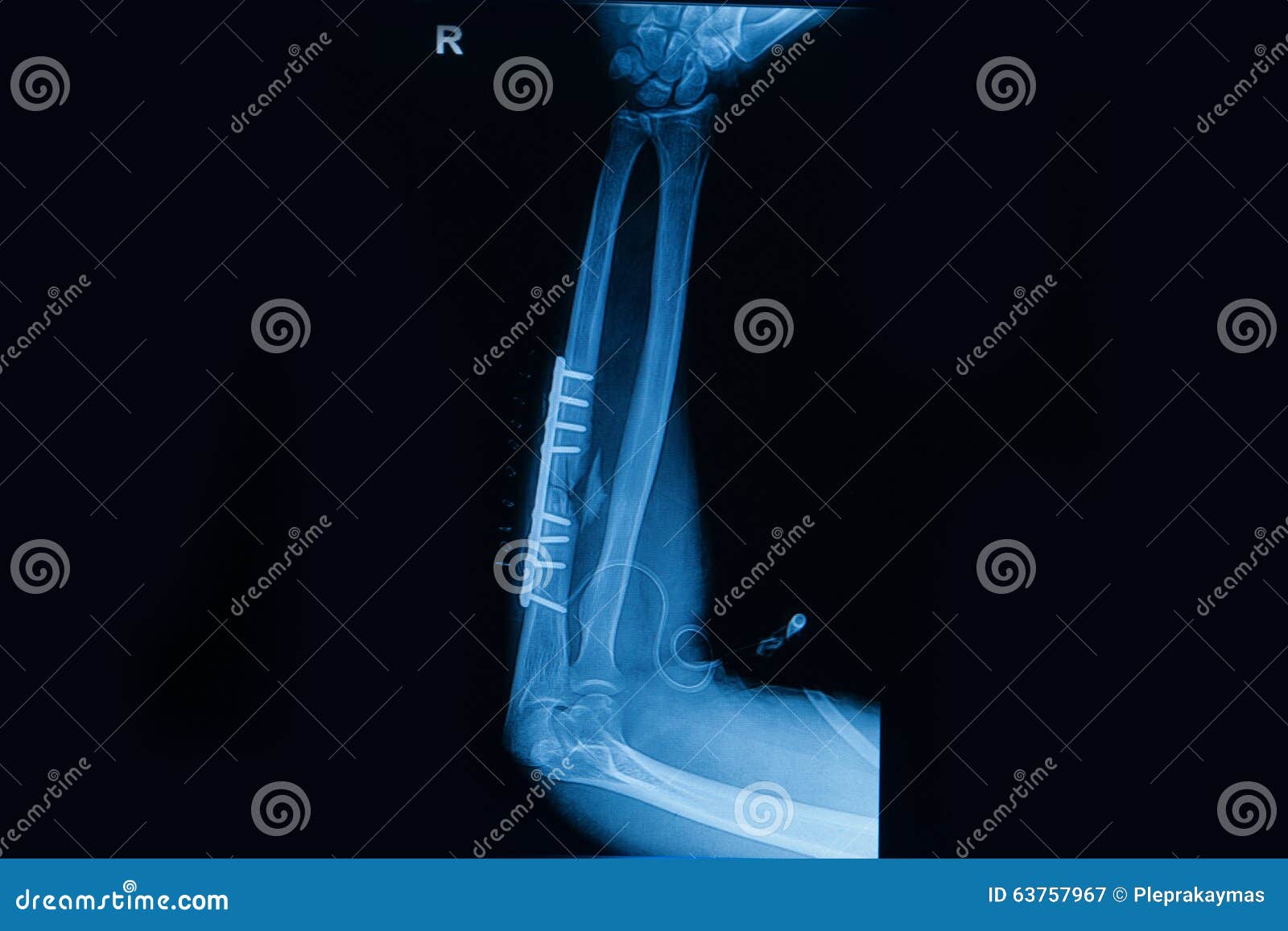 Dog X Ray Showing Radius And Ulna Fracture. Lateral View Stock ...