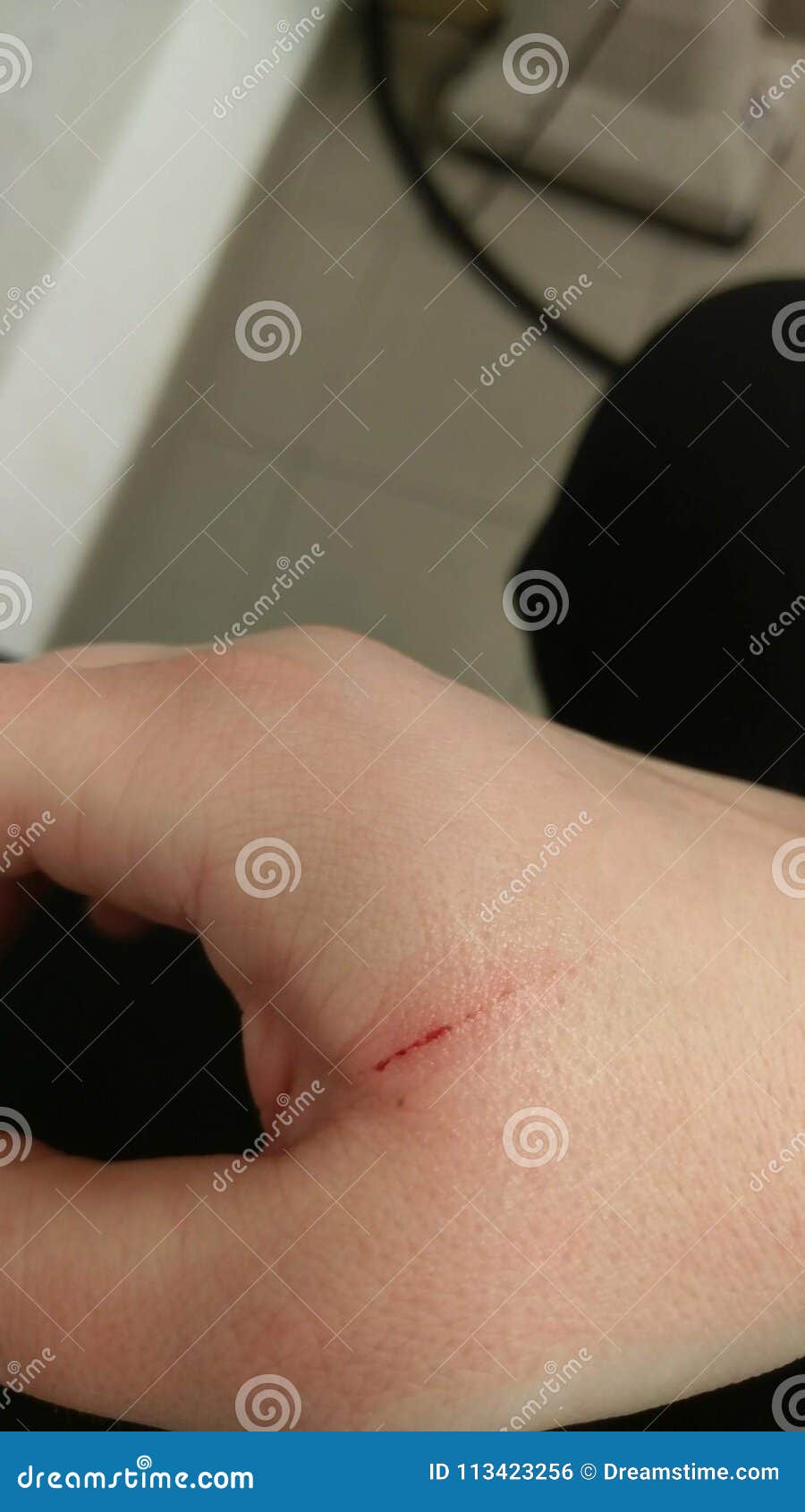 Hurt at work stock photo. Image of scar, work, injury - 113423256