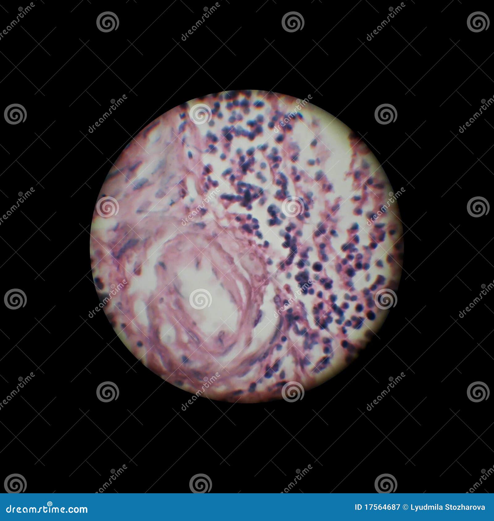 Hyalinosis of lien stock image. Image of science, microbiology - 17564687