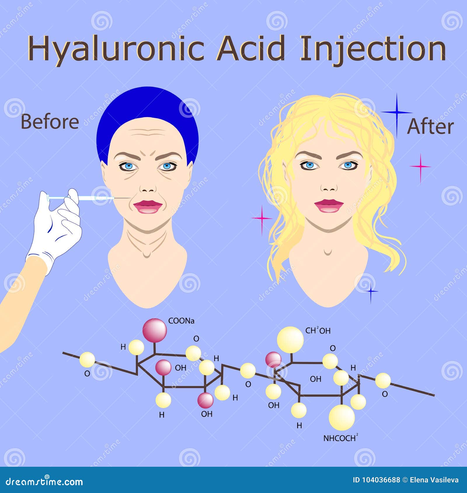 Hyaluronic Acid Injection, before and Affect , Vector Illustration ...